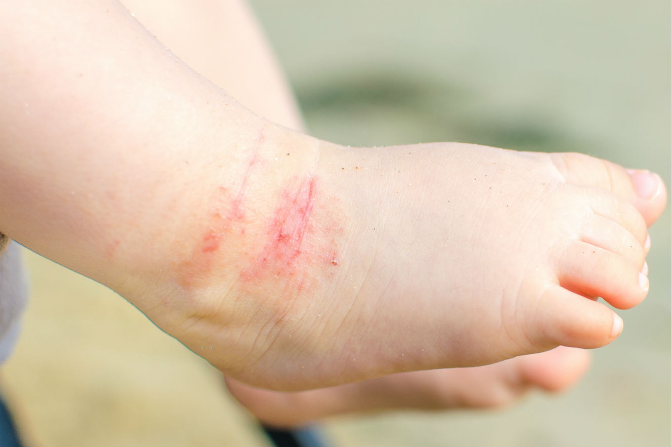 Dermatite atópica em bebês e crianças: os sinais e o tratamento | Bebe ...